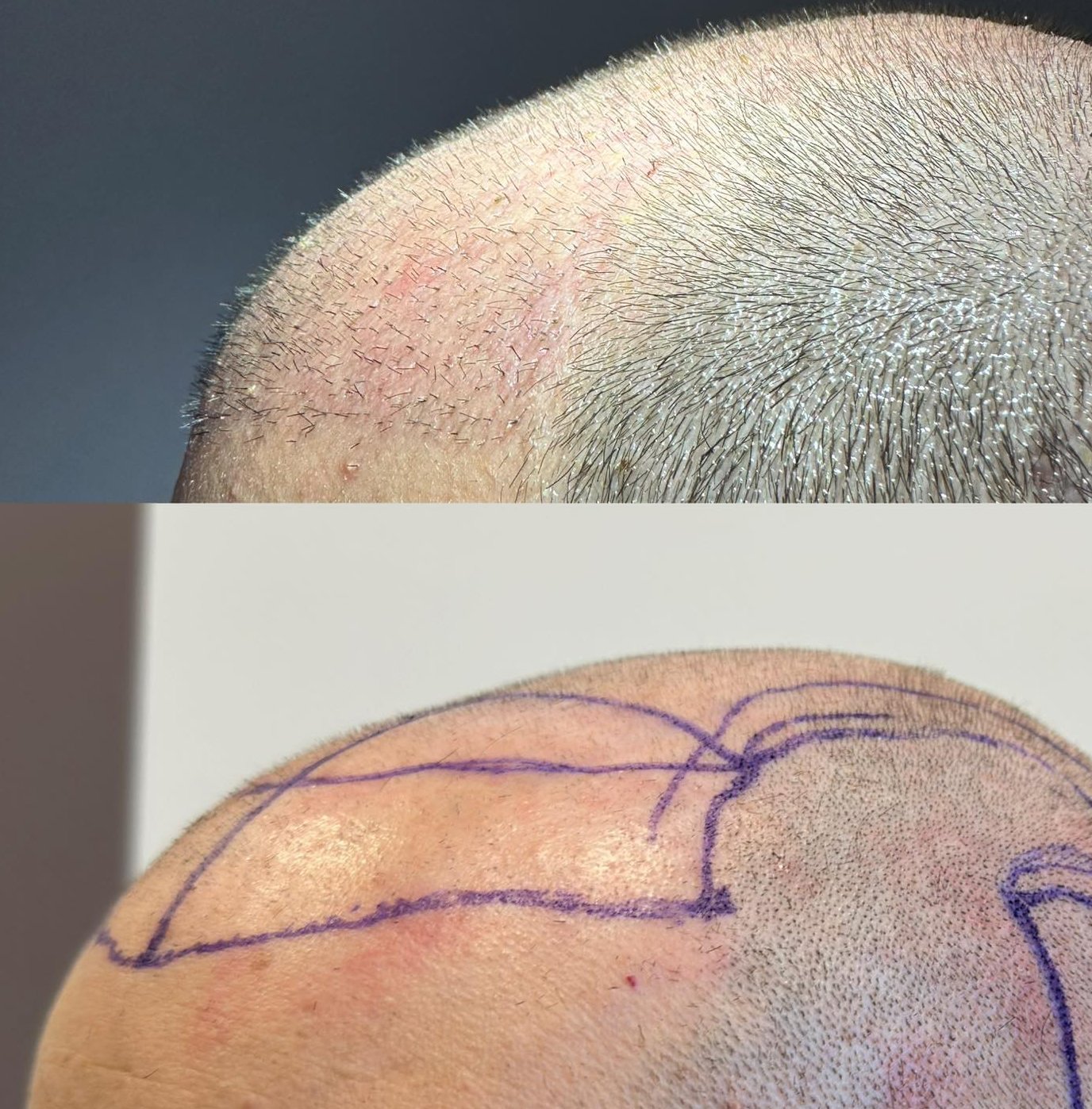Hair transplantation - Plastic Surgery Armenia
